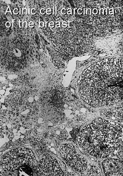 Acinic cell carcinoma of the breast - Moose and Doc
