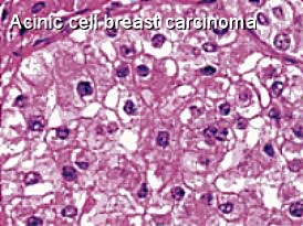 Acinic cell carcinoma of the breast - Moose and Doc