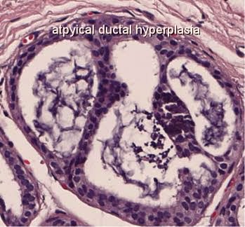 ADH and DCIS Histology grade affects risk - Moose and Doc