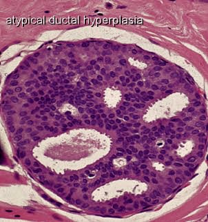 Proliferative changes histology - Moose and Doc