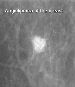 Breast vascular tumors - Moose and Doc