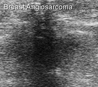 Angiosarcoma of the breast - Moose and Doc