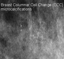 Breast columnar cell lesions - Moose and Doc