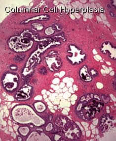 Breast columnar cell lesions - Moose and Doc