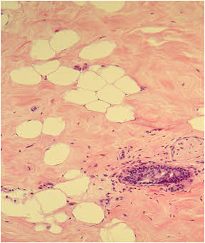 Fibroglandular Dysplasia of the breast - Moose and Doc