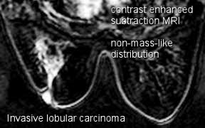ACR MRI lexicon of the breast