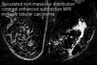 ACR MRI lexicon of the breast