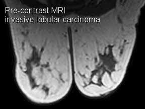 ACR MRI lexicon of the breast