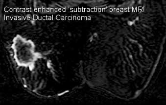 ACR MRI lexicon of the breast