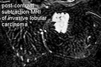 ACR MRI lexicon of the breast