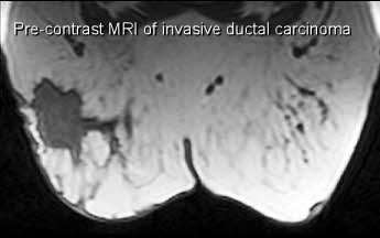 ACR MRI lexicon of the breast