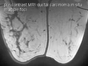 ACR MRI lexicon of the breast
