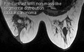 ACR MRI lexicon of the breast