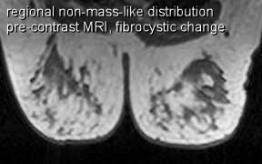 ACR MRI lexicon of the breast