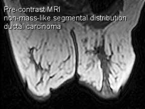 ACR MRI lexicon of the breast