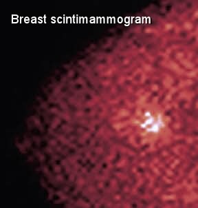 Why is Scintimammography done? - Moose and Doc