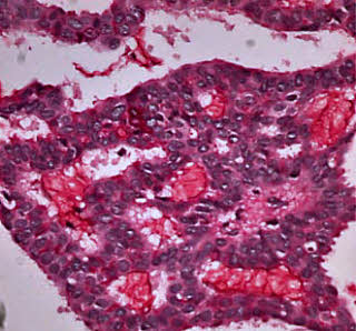 Columnar Cell Mucinous Breast Cancer - Moose and Doc