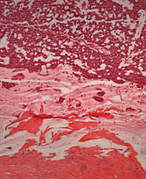 Columnar Cell Mucinous Breast Cancer - Moose and Doc