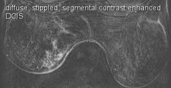 Detection of breast DCIS with MRI - Moose and Doc