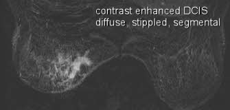 Detection of breast DCIS with MRI - Moose and Doc