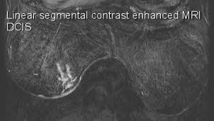 Detection of breast DCIS with MRI - Moose and Doc