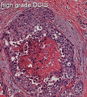 ADH and DCIS Histology grade affects risk - Moose and Doc