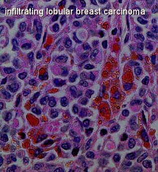 Invasive Lobular Carcinoma of the breast - Moose and Doc