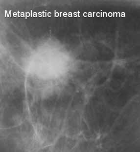 Metaplastic breast cancer - Moose and Doc