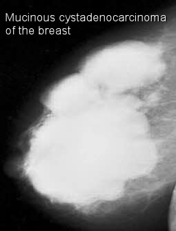 Mucinous cystadenocarcinoma of breast - Moose and Doc