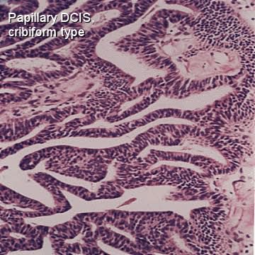 Grading and Types of DCIS, including papillary, cribriform