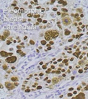 Pleomorphic Breast Cancer (Lobular) - Moose and Doc