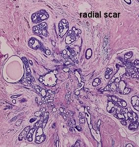 Fibrocystic Breast Disease - Moose and Doc