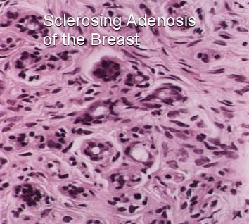 Sclerosing adenosis, calcifications led to breast biopsy