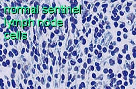 Sentinel lymph node, old secrets - Moose and Doc