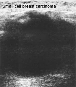 Small cell breast Cancer or Small Cell Breast Carcinoma - Moose and Doc