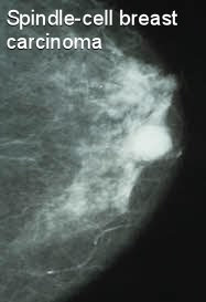 Spindle cell Carcinoma of the Breast - what is it? Moose and Doc