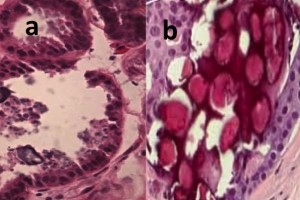 Benign Breast Conditions: cysts, fat necrosis and more - Moose and Doc