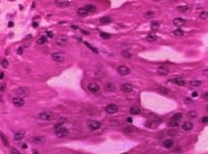 Benign Breast Conditions: cysts, fat necrosis and more - Moose and Doc