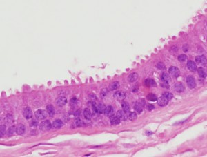 Intraductal papilloma and papillary carcinoma