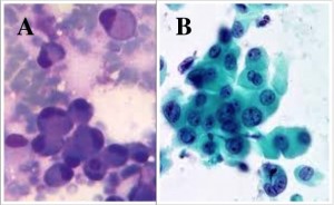 Types of Invasive Lobular Breast Cancer - Moose and Doc
