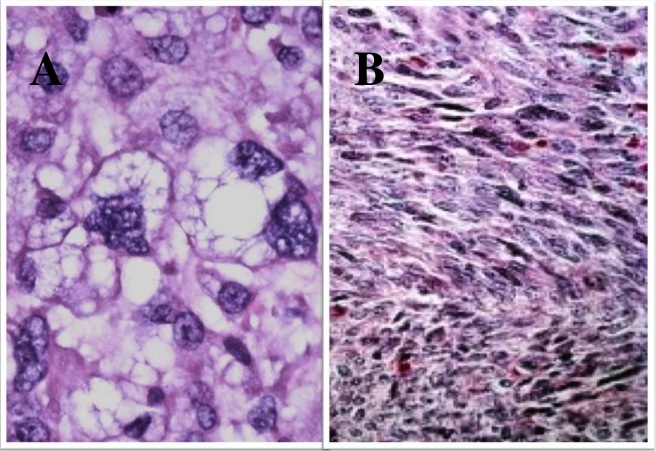 Rare Breast Cancers: Neuro-endocrine, Acinic and More - Moose and Doc