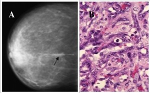 Rare Breast Cancers: Neuro-endocrine, Acinic and More - Moose and Doc